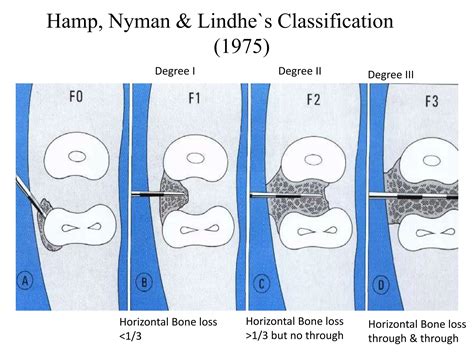 Bone Defects In Different Periodontal Diseasepptx Bone And Joint