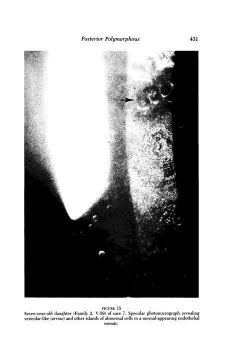 Posterior Polymorphous Corneal Dystrophy A Disease Characterized By