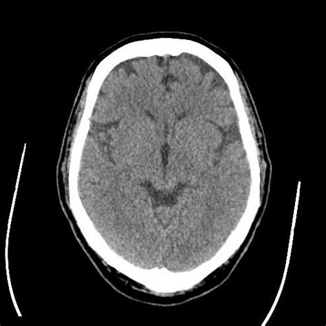 Subarachnoid Cisterns Stroke Manual