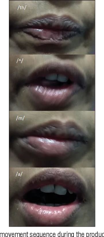 Figure 1 From Early Labial Compensation For Lingual Sounds Post Partial Glossectomy Semantic