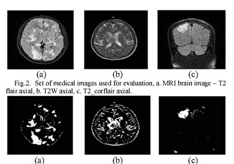 Figure 2 From Mri Brain Image Compression Using Spatial Fuzzy Clustering Technique Semantic