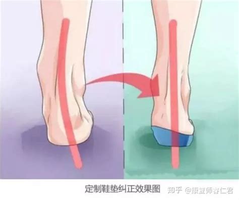 平足自测 怎么自我判断扁平足先天与后天有区别吗 知乎