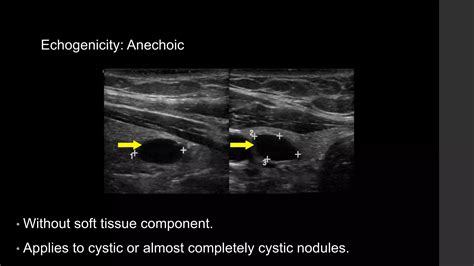 Thyroid Imaging Reporting And Data System Pptx