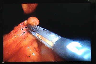 Gastrointestinal Stromal Tumor GIST The Gastrointestinalatlas Gastrointestinalatlas Com