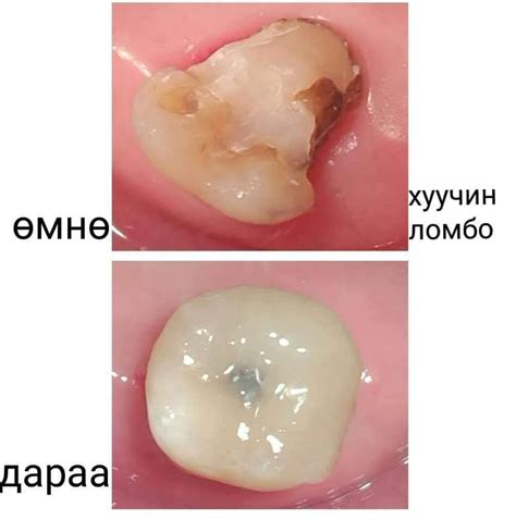 Хоёрдогч цоорол гэж юу вэ Цэгц Дент шүдний эмнэлэг Facebook