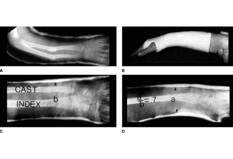 Casting And Splinting Principles And Common Pitfalls Ppt