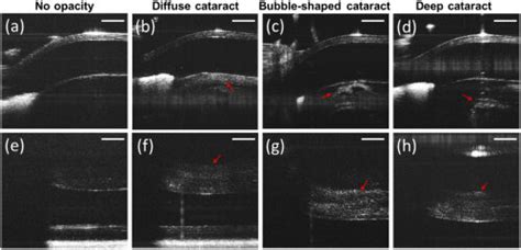 Examples Of Different Cataract Manifestations In Oct Details Of The Download Scientific