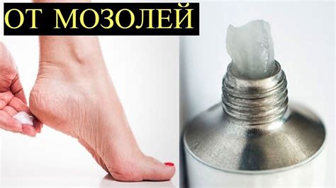 Эти Копеечные Мази помогут избавиться от Мозолей и Натоптышей на Ногах Плюс народный Рецепт