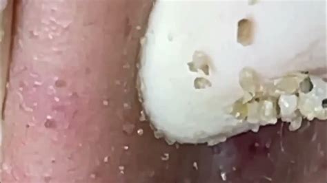 Выдавливание прыщей Акне Чистка Youtube