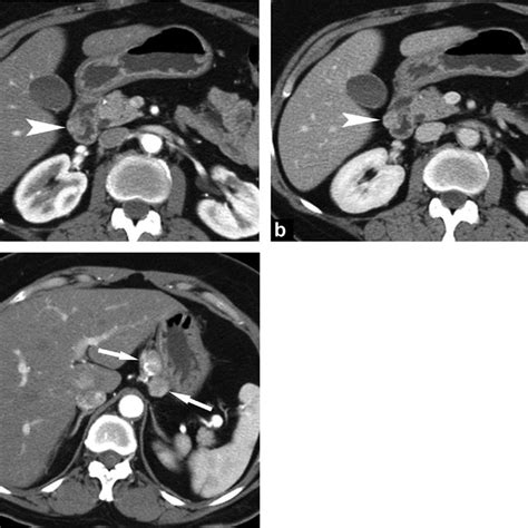 A 58 Year Old Man With Cystic Dystrophy Of Duodenal Wall A Ct Image Download Scientific