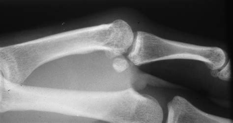 Reconstruction Thumb Metacarpophalangeal Joint Arthrodesis With Plates And Screws