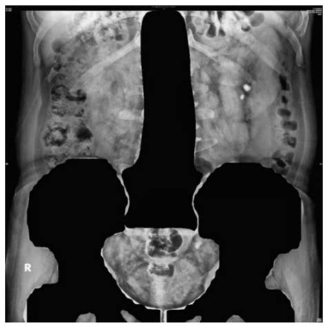 Design And Validation Of A Deep Learning Model For Renal Stone Detection And Segmentation On