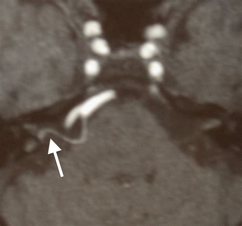 Vascular Loop Louis Hofmeyr