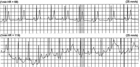 Short Qt Syndrome Ecg Book