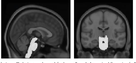 Figure 2 From Automated Segmentation Of Cerebellum Using Brain Mask And Partial Volume