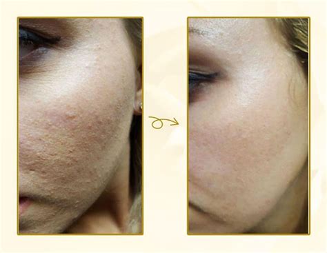 Subcision Pro Age Clinic UAE