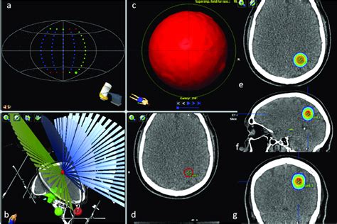 Simulated Plan For A Typical Radiosurgery Case Using A Treatment Download Scientific Diagram
