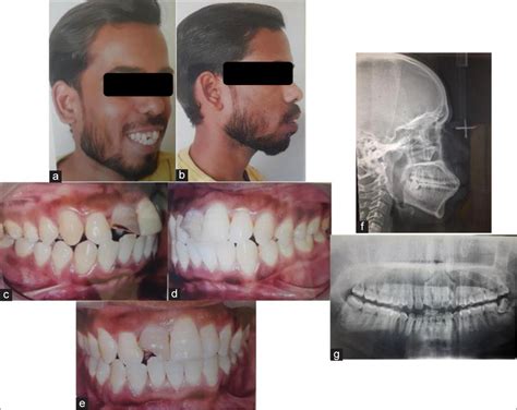 Treatment Modalities For Management Of Skeletal And Dental Class Iii Malocclusion A Case