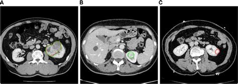 Examples Of Renal Mass Segmentation A True Positive The Predicted Download Scientific