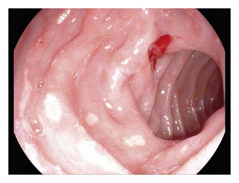 Duodenal Bulb 2nd Portion Of The Duodenum And Gastric Antrum With Download Scientific Diagram
