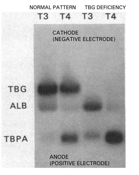 Thyroxine Binding Globulin My Endo Consult