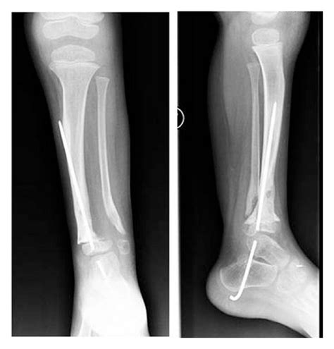Clinical Effect Of The Use Of Combined Bm Hmsc Based Technique