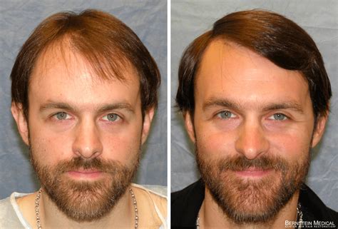 Patient Gel Bernstein Medical Center For Hair Restoration