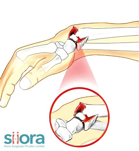 Everything You Need To Know About Smiths Fracture Wongcw