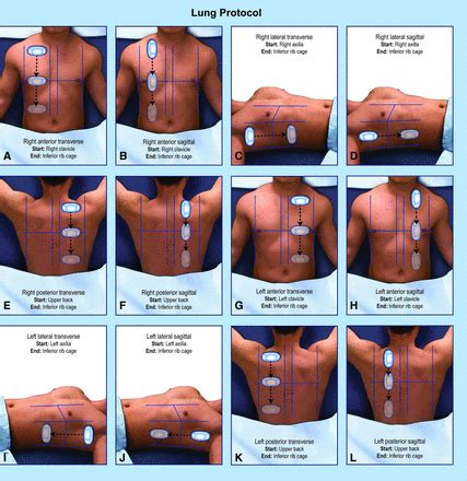 Lung Ultrasound Volume Sweep Imaging For Respiratory Illness A New