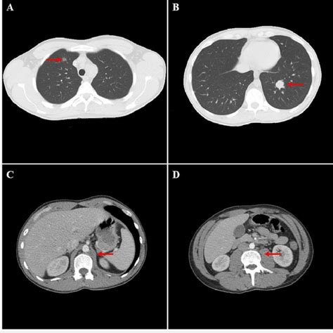 Ct Chest After The Completion Of Four Cycles Of Bep Chemotherapy Showed