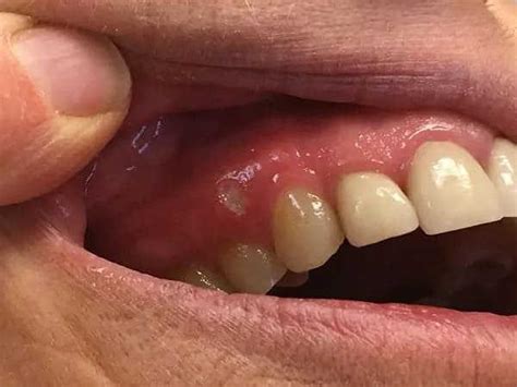Tại Sao Bị Nhiệt Miệng Kiến Thức Sức Khỏe Mỗi Ngày