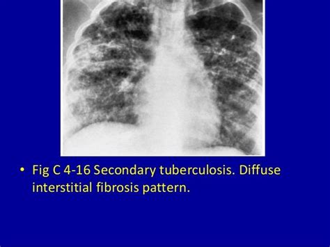4 Diffuse Reticular Or Reticulonodular Pattern