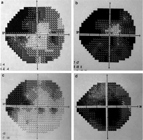 Patient 8 Serial Visual Field Tests For The Right Eye Of A 40 Year Old Download Scientific