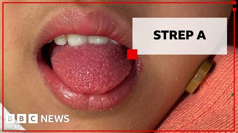 Strep A Symptoms What You Need To Know In A Minute
