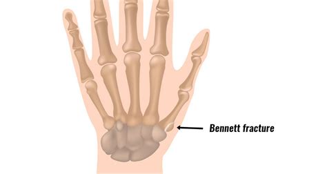 Bennetts Fracture Symptoms Causes Treatment And Rehabilitation