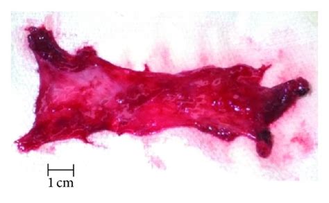 Tissue Removed From The Patients Right Shoulder During The Download Scientific Diagram
