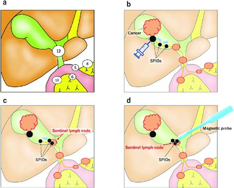 Regional Lymph Node Map For Gallbladder Cancer And The Procedure For