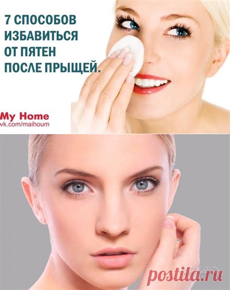 КАК ИЗБАВИТЬСЯ ОТ ПЯТЕН ПОСЛЕ ПРЫЩЕЙ Красота страшная сила Постила