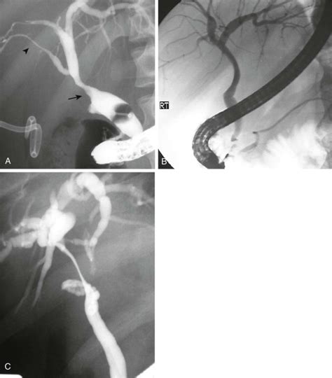 Endoscopic Retrograde Cholangiopancreatography Radiology Key