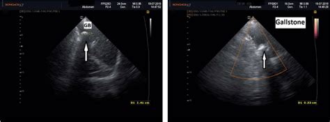 A Left 2d Abdominal Ultrasound White Arrow Pointing At Gs