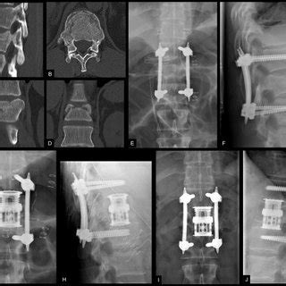 ATLS Algorithm And Spine Trauma Assessment In Step A Cervical Spine Download Scientific