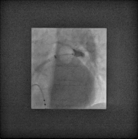 Example Of Stored Fluoroscopic Image During Occlusion Of The Left Download Scientific Diagram