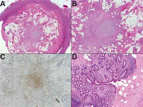Fibrous Obliteration Of The Appendix A Central Obliterative Lesion