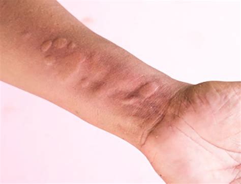 Ways To Get Rid Of Hives