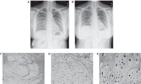 Figure 3 From A Rare Case Of Primary Chondrosarcoma Arising From The Sternum A Case Report