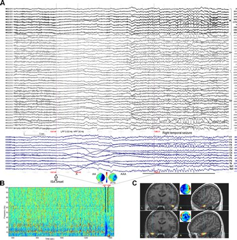 A Simultaneous Meg And Eeg Recording Of A Right‐sided Pilomotor