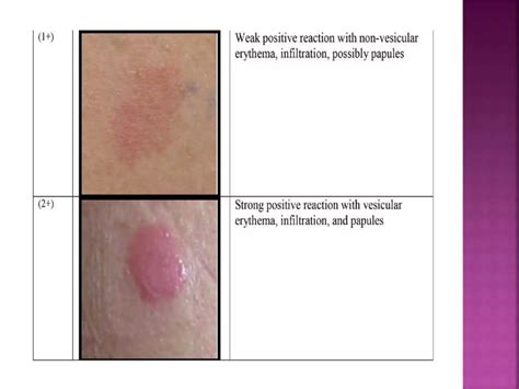 Patch Test In Dermatology PPTX