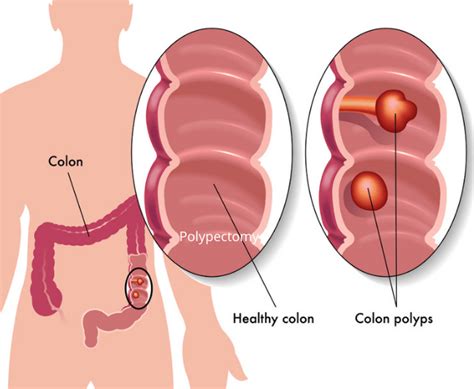 What Is Emr Polypectomy Gastroenterologist In Cape Town Dr Deetlefs