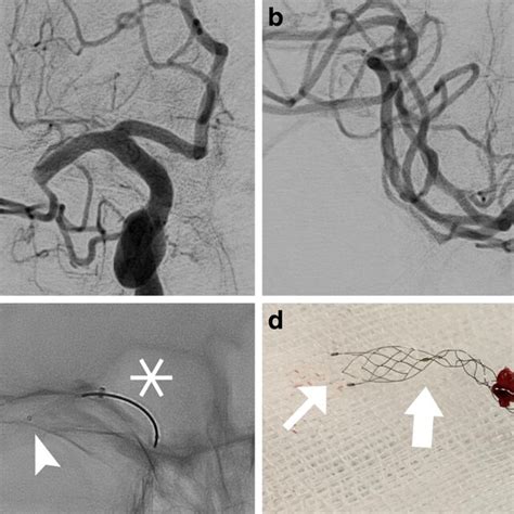Occlusion Of The M1 Segment Of The Right Middle Cerebral Artery Download Scientific Diagram