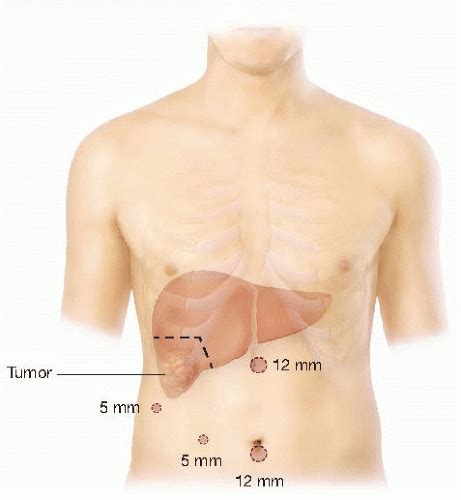Minimally Invasive Sectional And Segmental Hepatic Resection Basicmedical Key